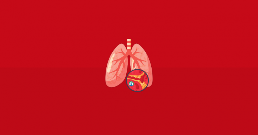 Chronic Bronchitis: Overview and Practice Questions