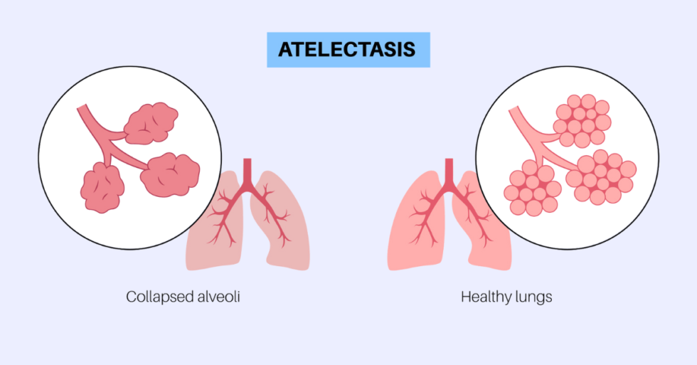 Lung Expansion Therapy: Overview and Practice Questions