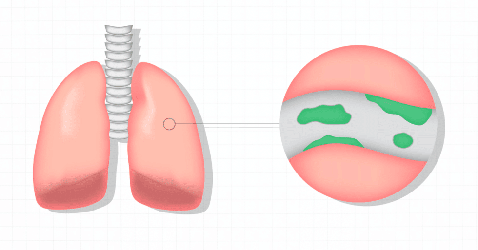 The 29+ Early Warning Signs of Asthma You Must Know (2026)