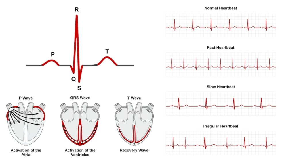 Cardiac Electrophysiology: Overview and Practice Questions