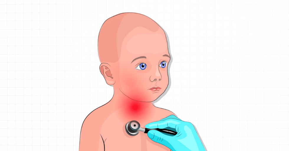 Croup: Overview and Practice Questions (2025)