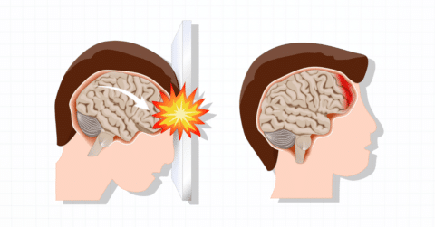 Head Trauma: Overview and Practice Questions (2025)
