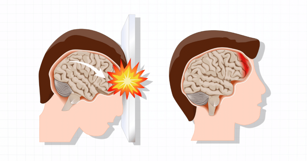 Head Trauma: Overview and Practice Questions (2025)