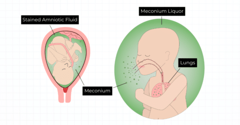 Meconium Aspiration Syndrome: An Overview (2026)