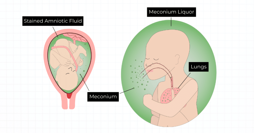 Meconium Aspiration Syndrome: An Overview (2026)