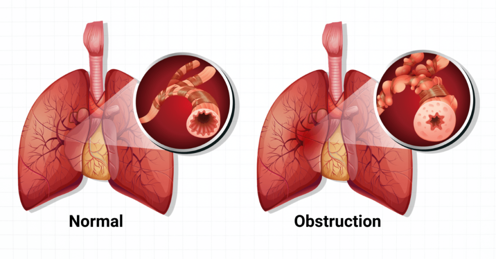 Obstructive Lung Diseases: Overview and Practice Questions