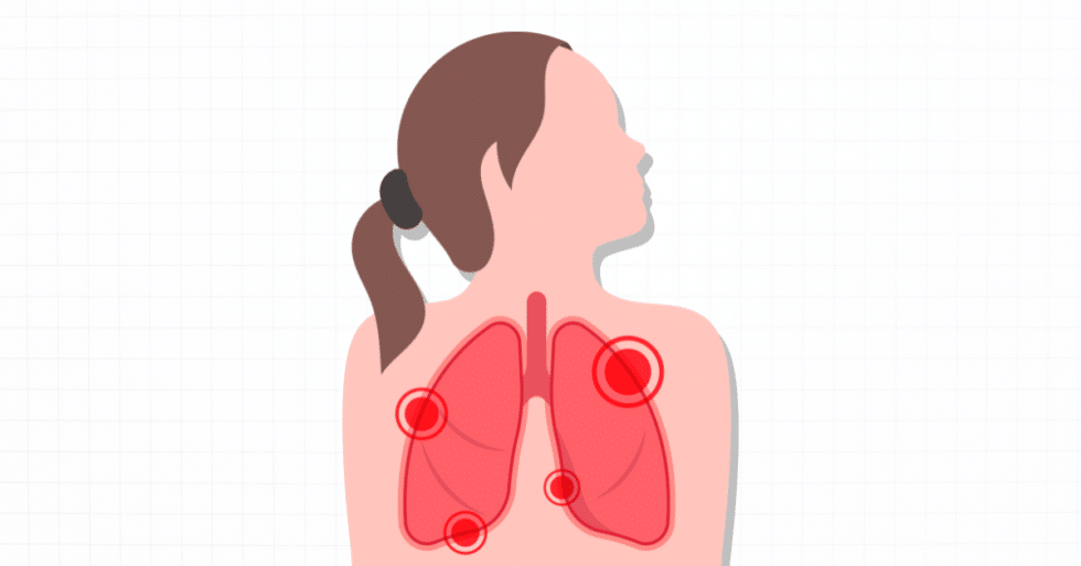 Restrictive Lung Diseases: Overview and Practice Questions