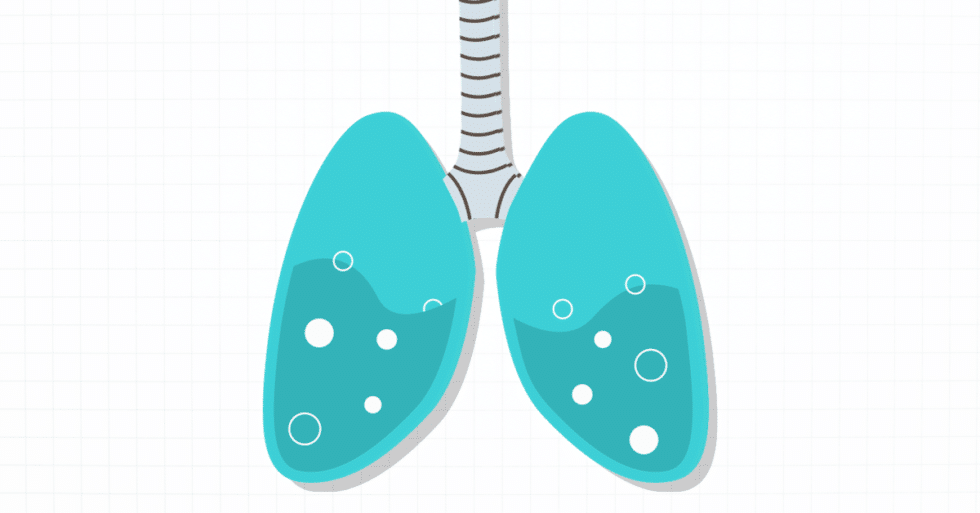 Acute Respiratory Distress Syndrome (ARDS): An Overview