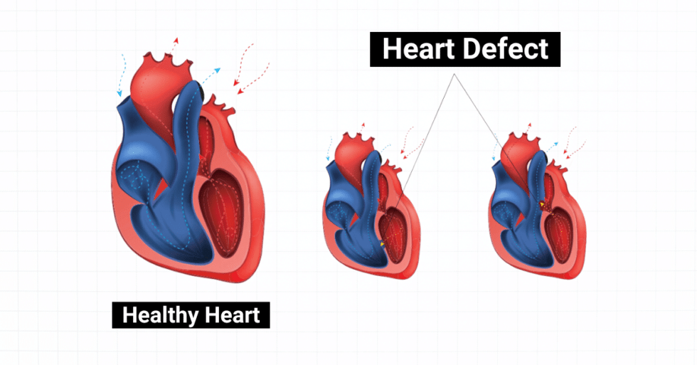 Congenital Heart Defects: Overview and Practice Questions