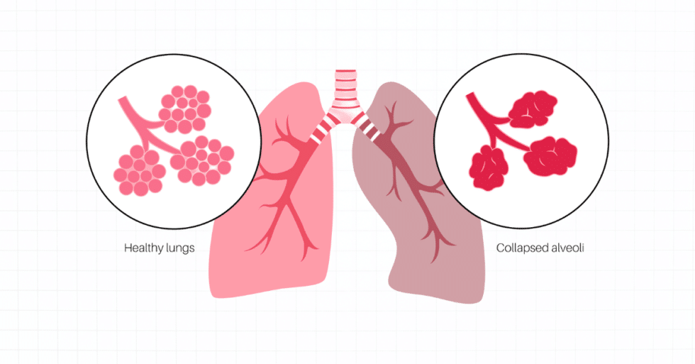 Emphysema: Overview and Practice Questions (2025)