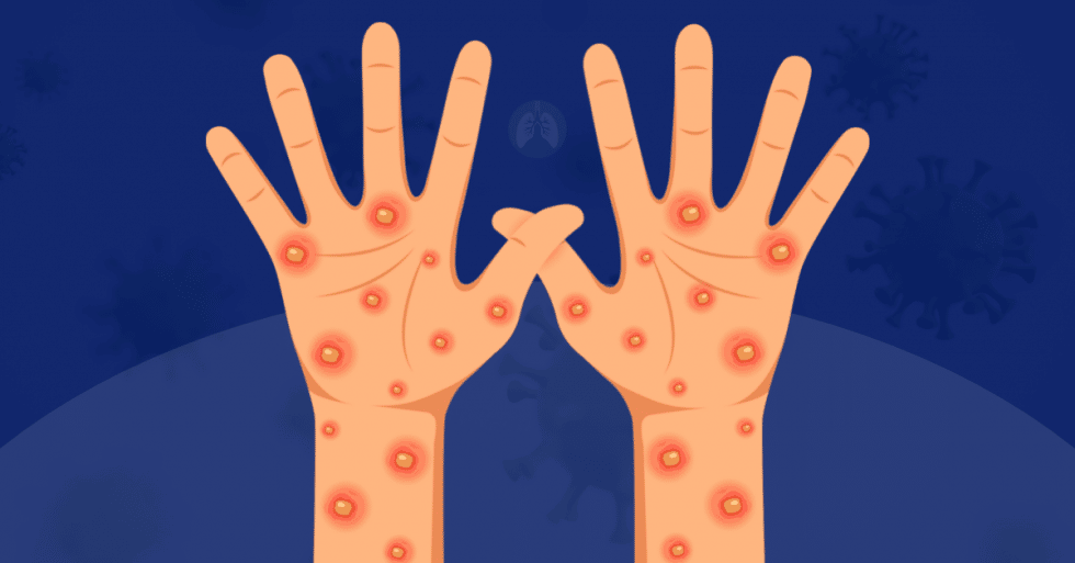 What is the Tomato Flu? (Explained)