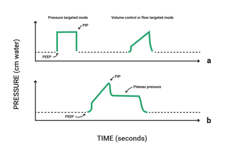 Ventilator Waveforms and Graphics: An Overview (2025)