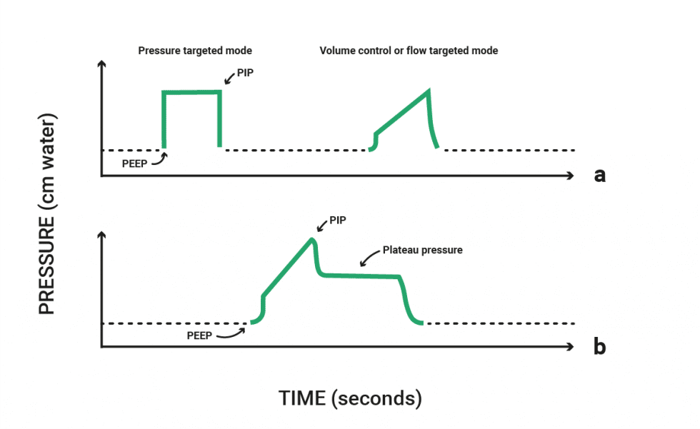 Ventilator Waveforms and Graphics: An Overview (2026)
