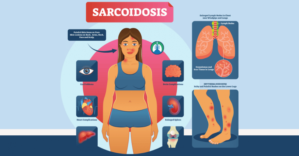 Sarcoidosis Diet: Top 15 Best and Worst Foods to Eat (2025)