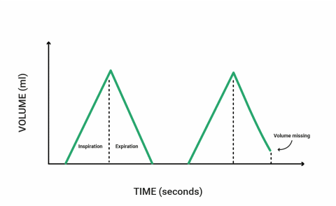 Ventilator Waveforms and Graphics: An Overview (2025)