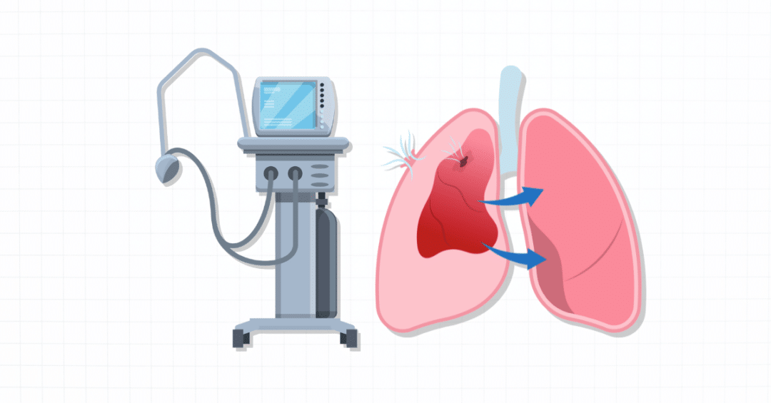 Ventilator-Induced Lung Injury (VILI): An Overview (2024)