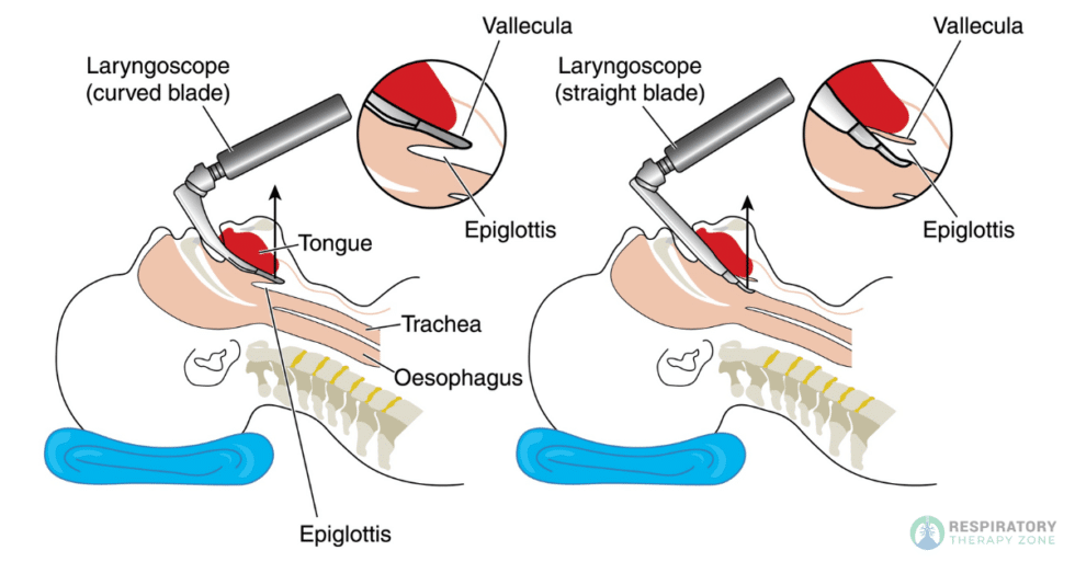 Epiglottic Vallecula: A Key Landmark for Intubation (2024)