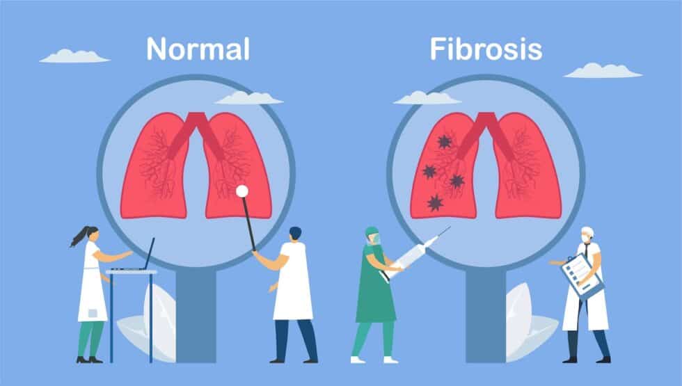 15+ Pulmonary Fibrosis Stage 4 Symptoms (and Treatment)