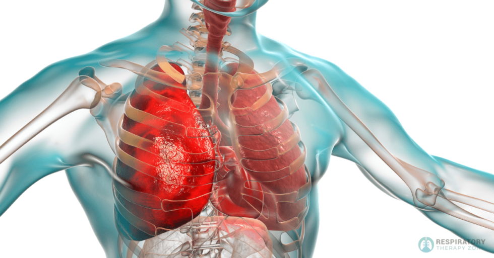 List of 97+ Cardiopulmonary Diseases You Should Know (2023)