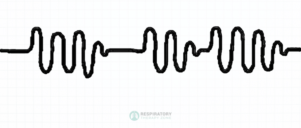 Biot's Breathing Pattern: An Overview (2024)