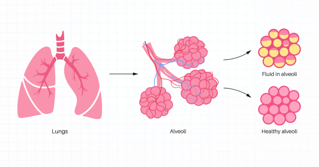 Pulmonary Edema vs. Pneumonia: An Overview (2024)