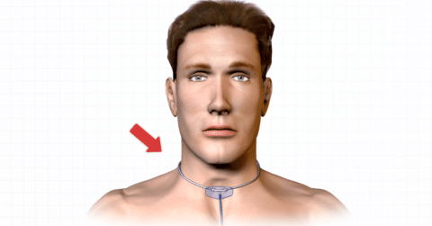 What is a Transtracheal Oxygen Catheter? (2025)