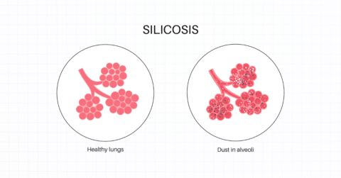 Silicosis: Causes, Symptoms, Diagnosis, and Treatment (2024)