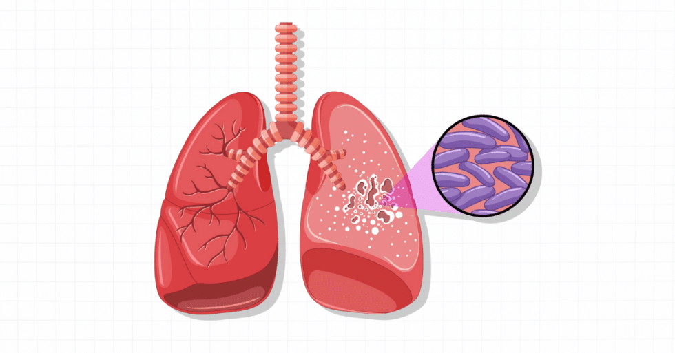 Tuberculosis (TB): Causes, Symptoms, Treatment (2025)