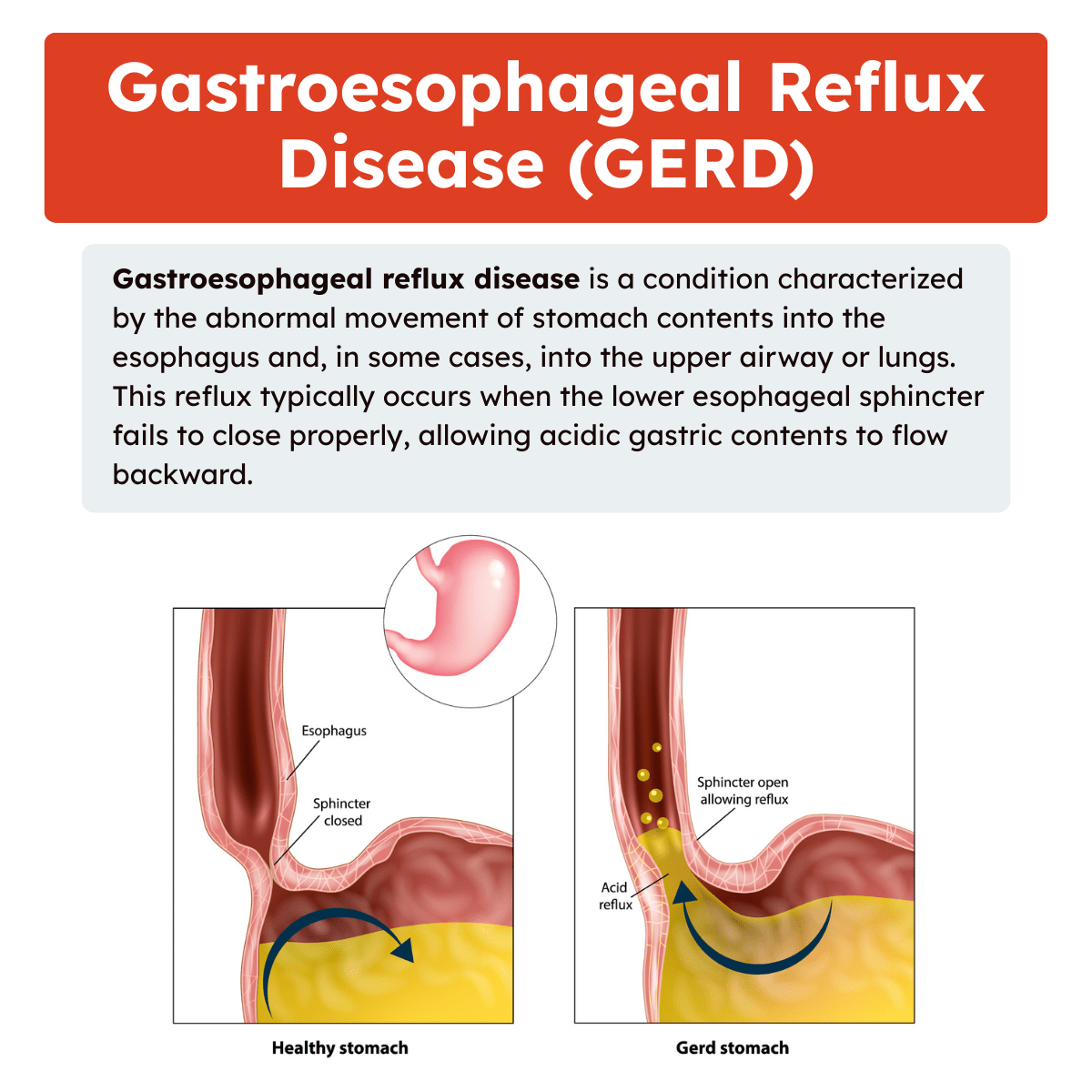 Gastroesophageal Reflux Disease (GERD) and the Lungs (2026)