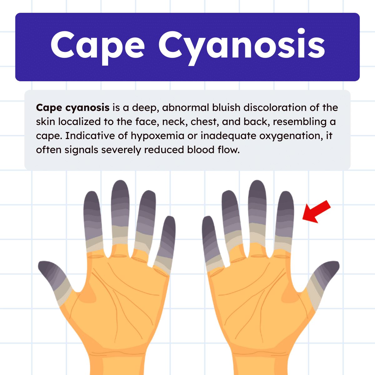 Differential Cyanosis In Upper Limb