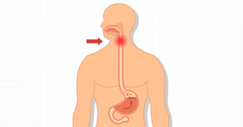 Laryngopharyngeal Reflux: Causes and Treatment (2025)