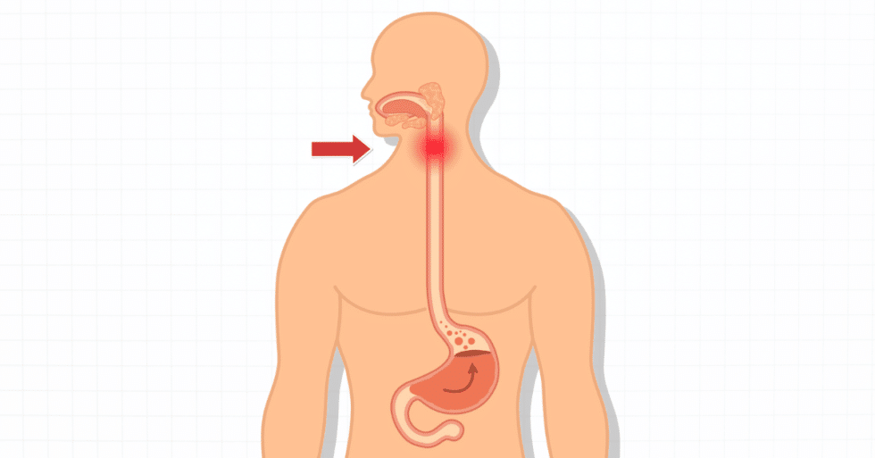 Laryngopharyngeal Reflux: Causes and Treatment (2025)