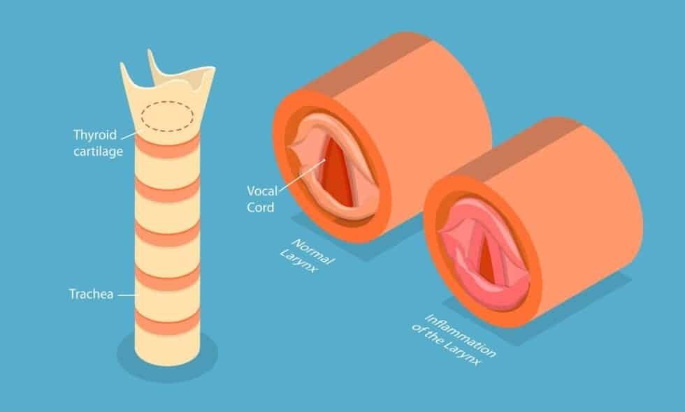Tracheal Disorders: Types, Symptoms, and Treatment (2025)