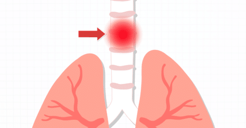 Tracheal Disorders: Types, Symptoms, and Treatment (2025)