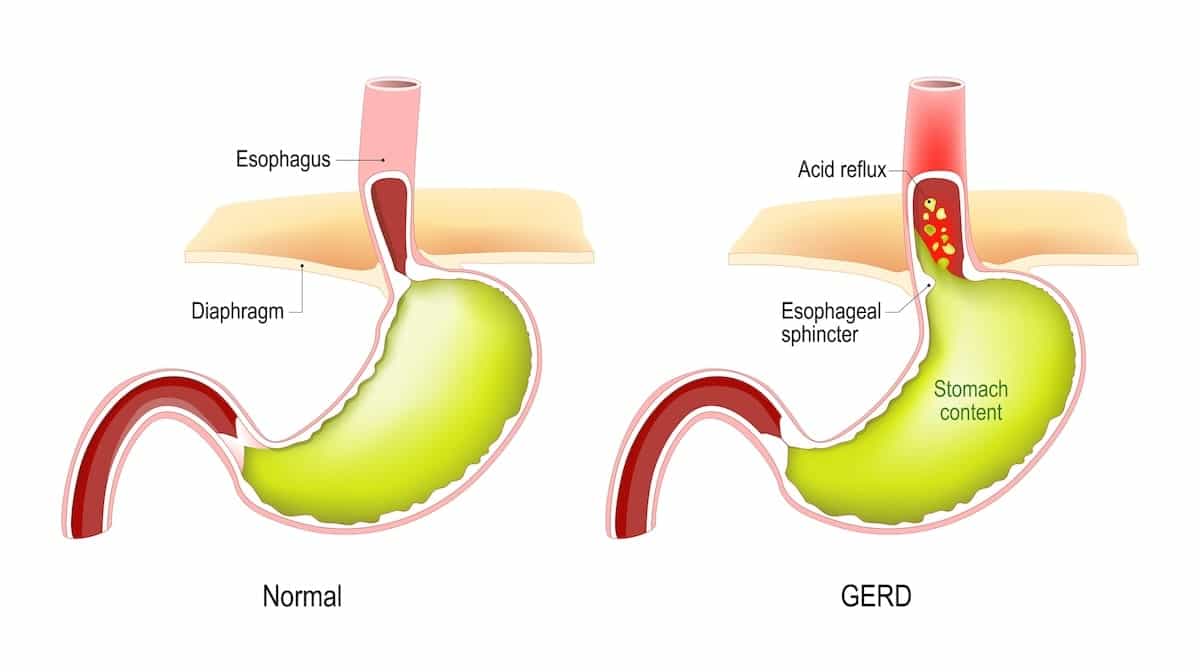 Can Acid Reflux Cause A Cough With Mucus 2025 