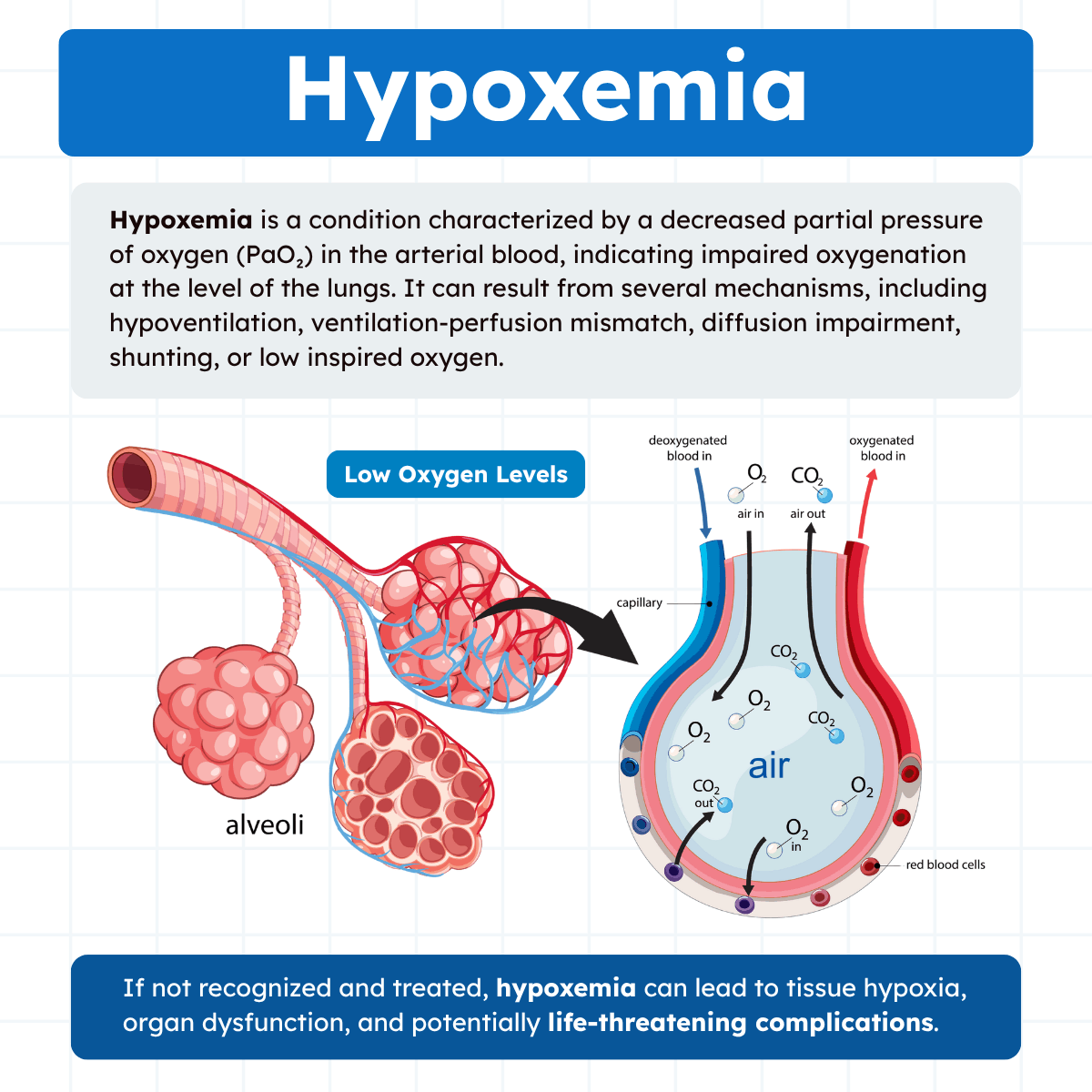 Hypoxemia: Causes, Mechanisms, and Clinical Implications