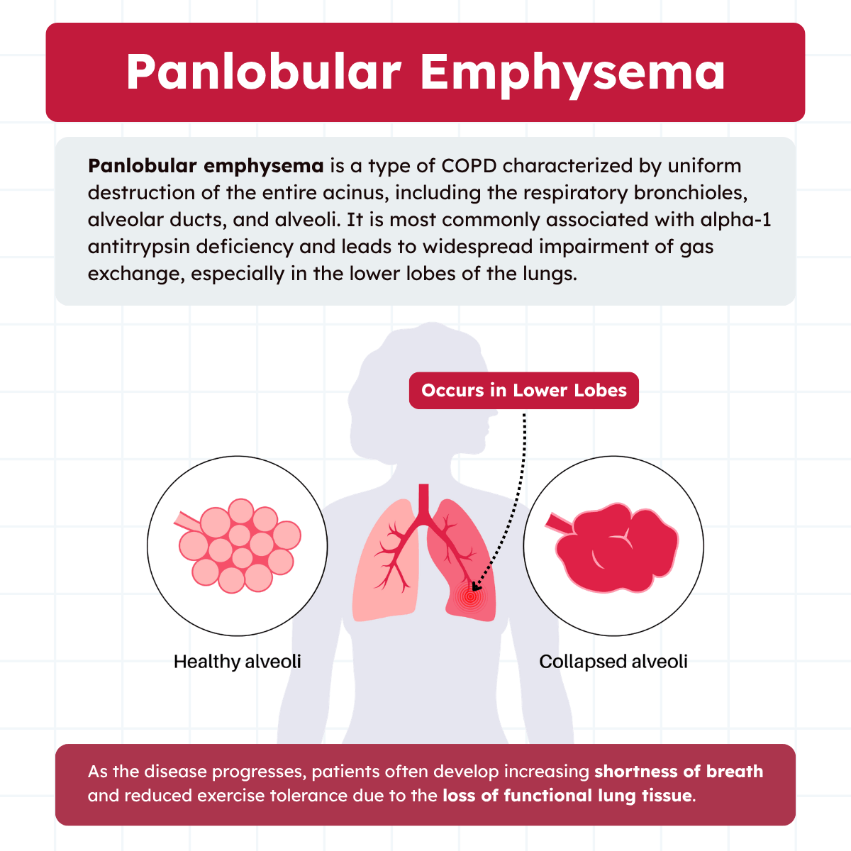 Panlobular Emphysema: Causes, Symptoms, and Treatment