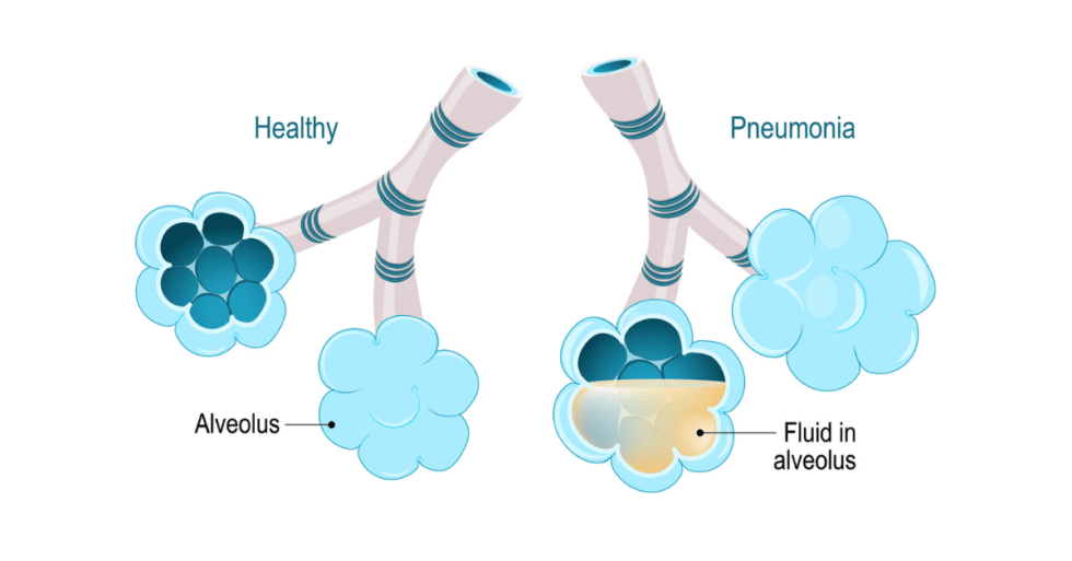 Can Mucinex Help with Pneumonia? (2024)