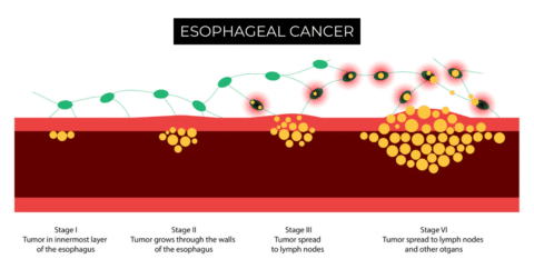 Top 10 Early Warning Signs of Esophageal Cancer (2025)