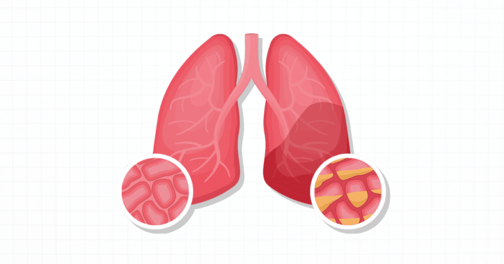 Top 10 Early Warning Signs of Pneumonia (2025)