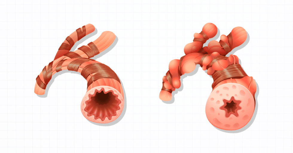 Bronchodilators: Overview and Practice Questions (2025)