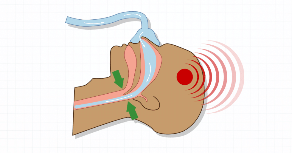 COPD Headaches: Causes, Symptoms, and Treatment (2025)