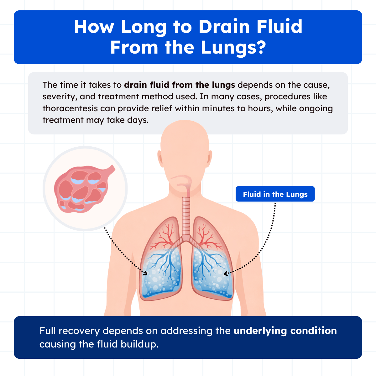 How Long Does it Take to Drain Fluid From the Lungs? (2026)