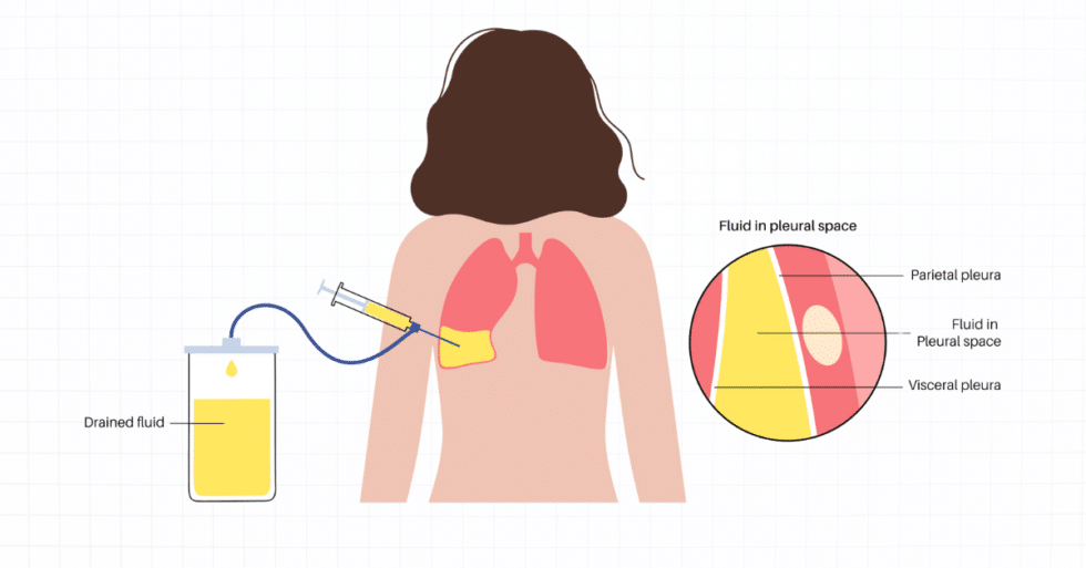 What Color is Fluid Drained From the Lungs? (2025)