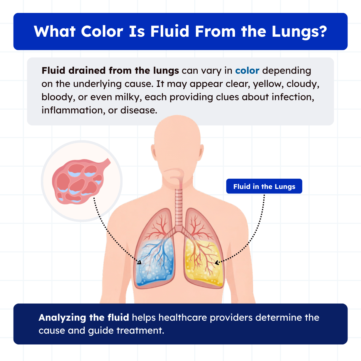 What Color is Fluid Drained From the Lungs? (2026)