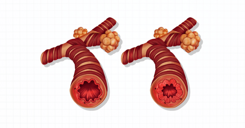 Wheezing: Overview and Practice Questions (2025)
