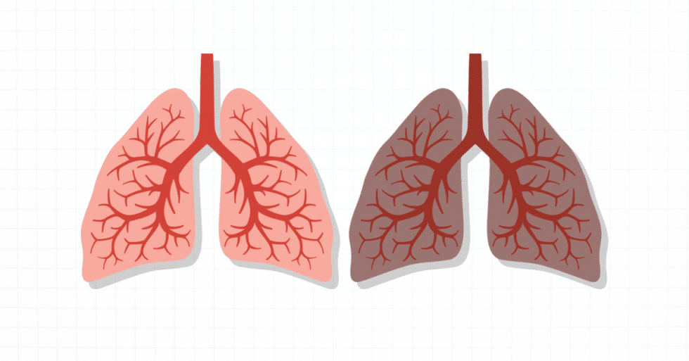 Healthy Lungs vs. Smokers' Lungs: An Overview (2025)