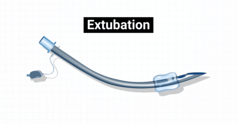 Extubation: Overview and Practice Questions (2025)