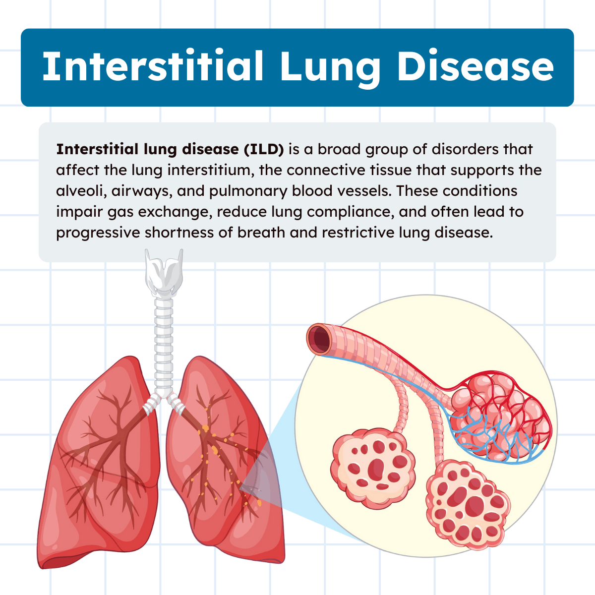 Interstitial Lung Disease Prognosis