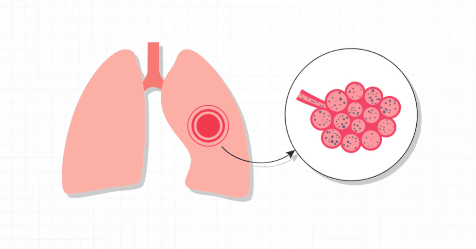 Interstitial Lung Disease: Overview and Practice Questions